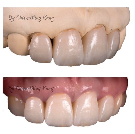 Aidite 3D pro Zir (full contour zirconia restoration material) – Dental ...